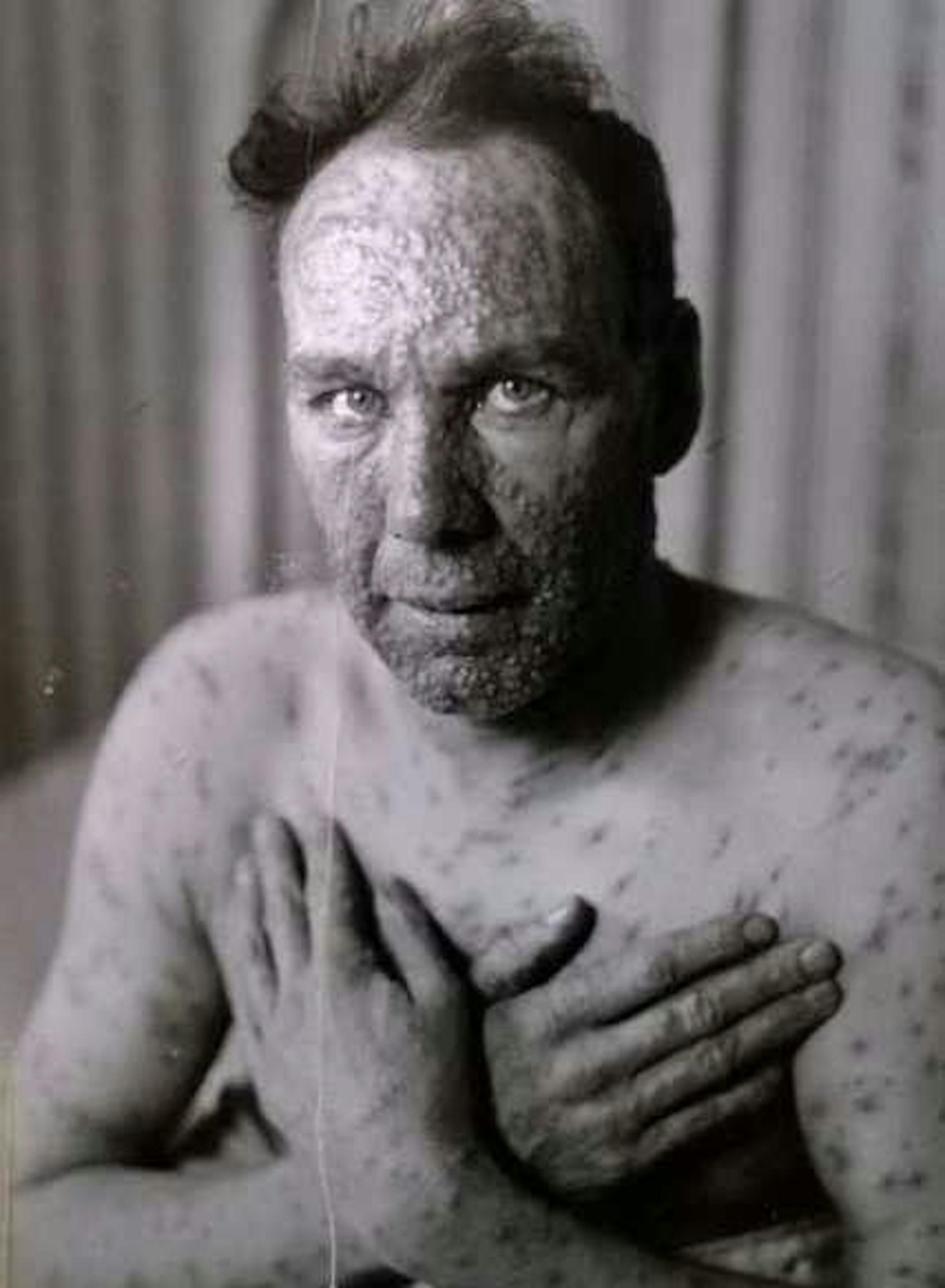Minneapolis anti-vaxxer's death in 1903 resonates today