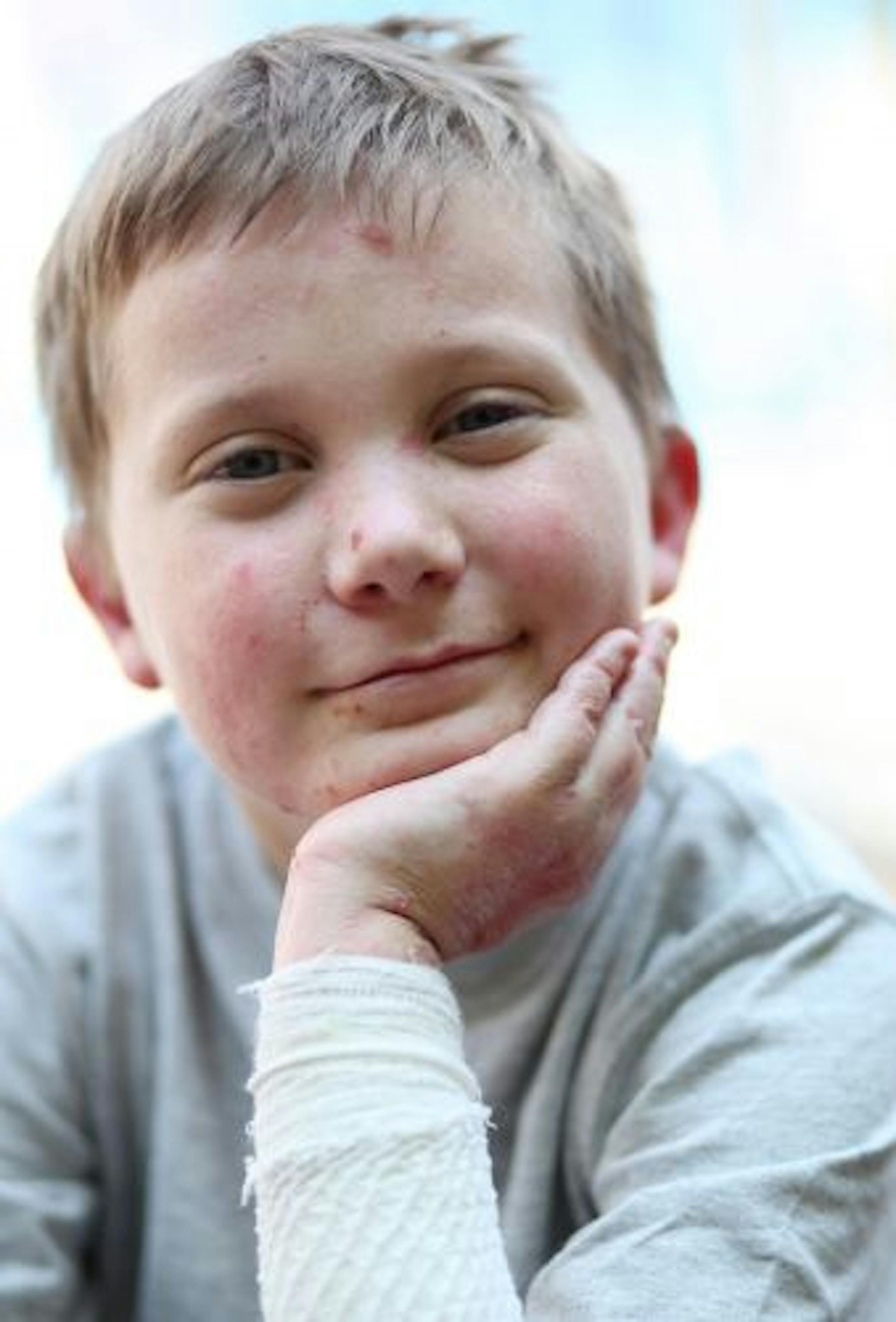 U doctors find treatment for painful, lethal skin disease