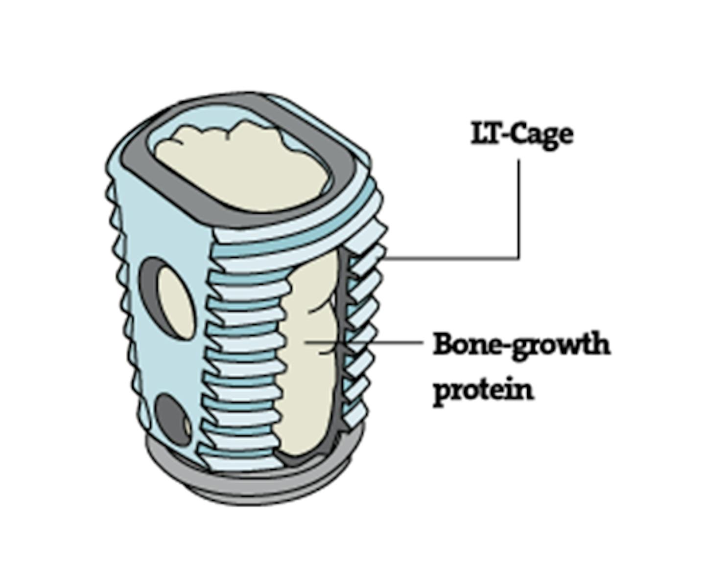 6 questions about Infuse, Medtronic's spinal fusion device