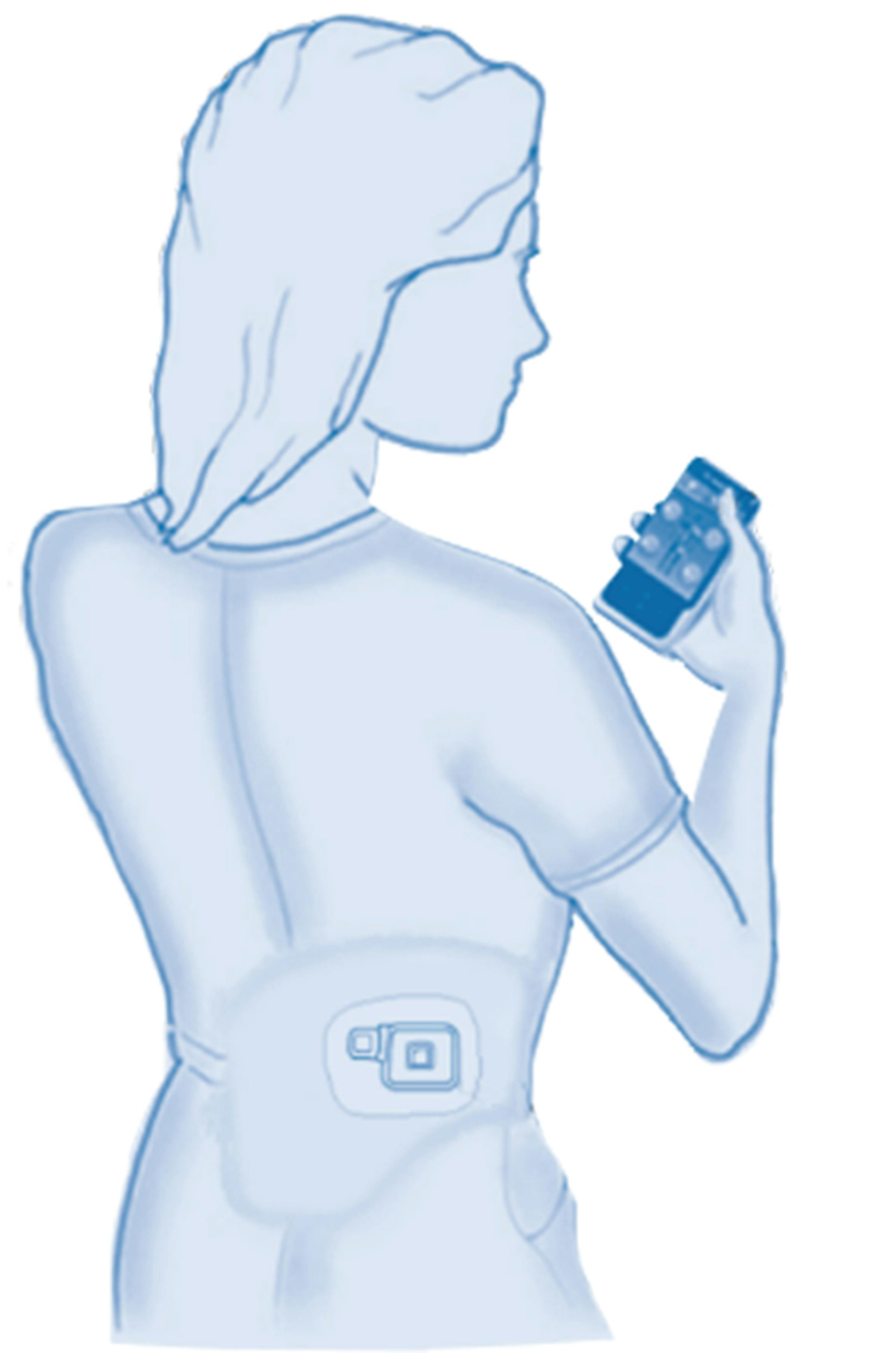 Medtronic device helps downsize the shame over incontinence