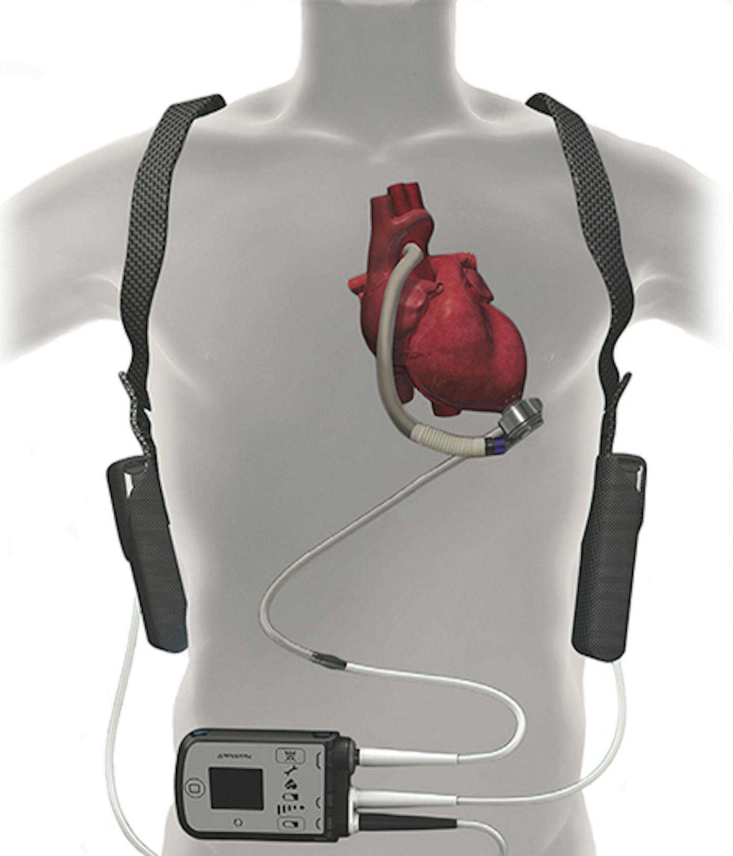 Abbott's HeartMate 3 pump shows improved results in clinical trial